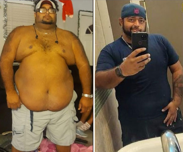 Weight Loss Surgery Before And After Moon Gastric Sleeve Weight Loss Surgery Before And After Moon Gastric Sleeve