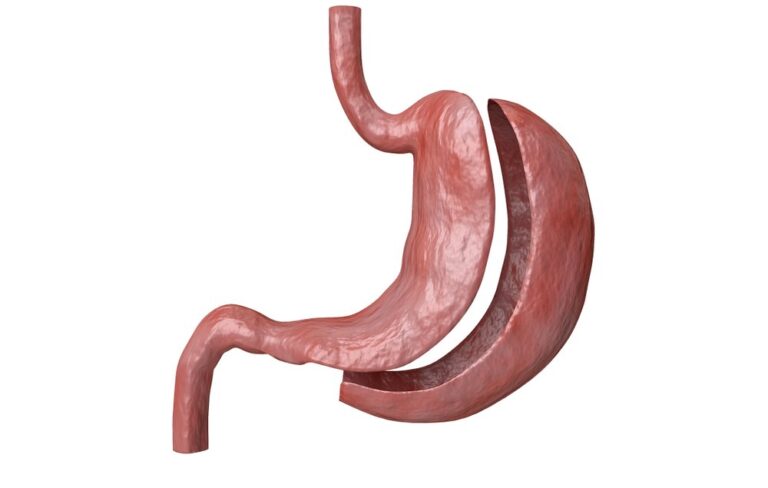 Gastric Sleeve vs. Gastric Bypass: Surgical Options Compared