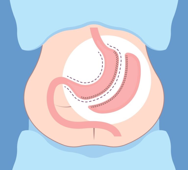 Gastric Sleeve Revision To Bypass Reviews Real Experiences